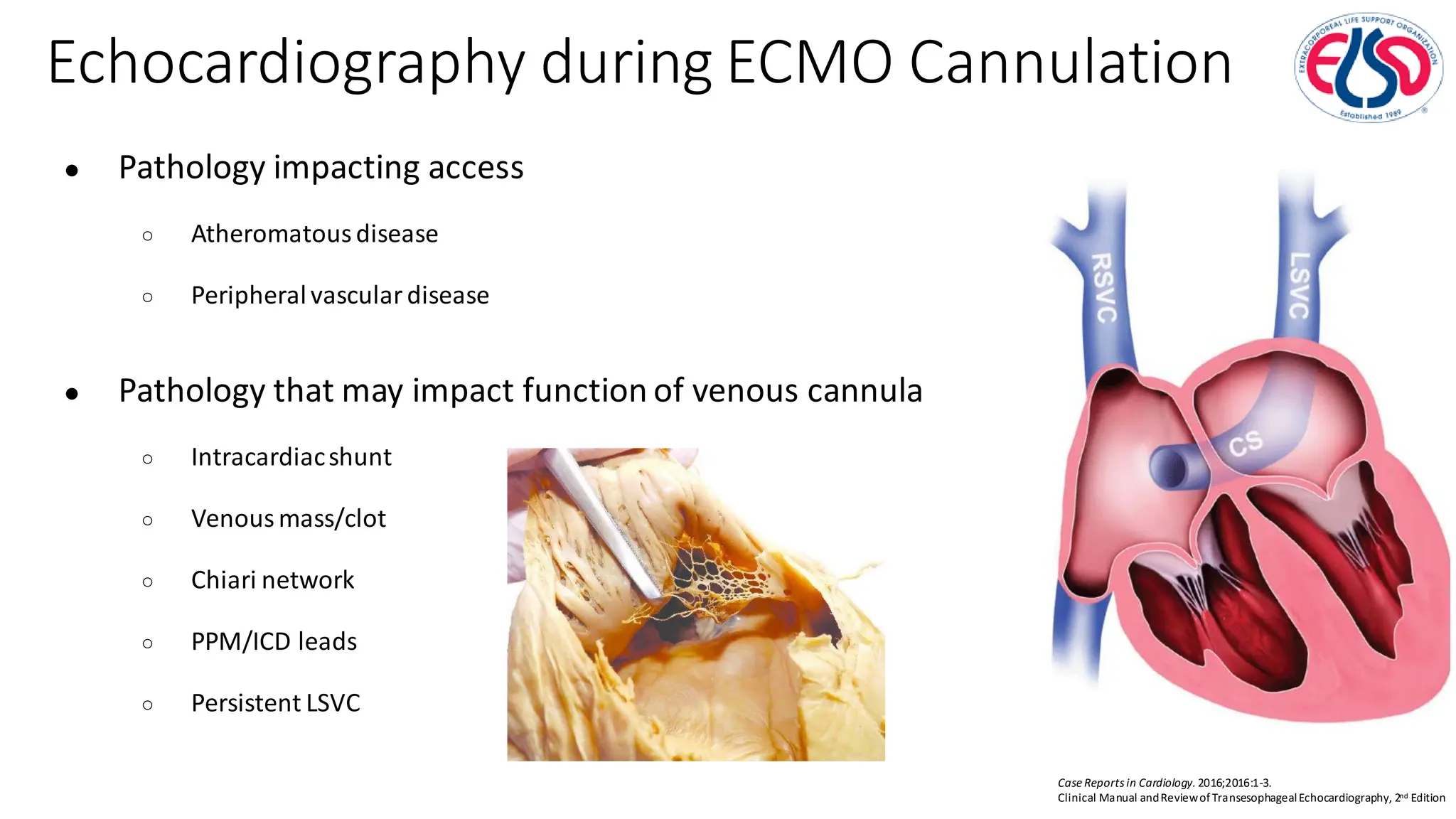 2 - Advanced ECMO Management Strategies.pdf | Heart and Cardiovascular Diseases | Diseases and ...