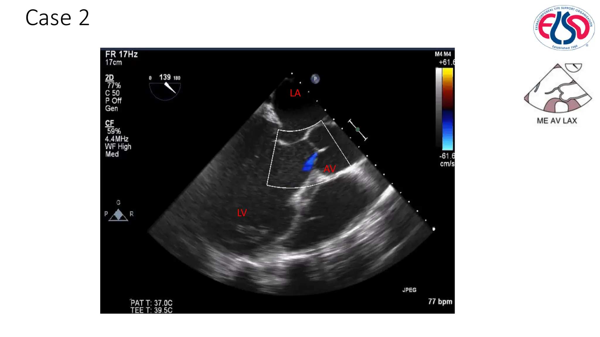 2 - Advanced ECMO Management Strategies.pdf | Heart and Cardiovascular ...