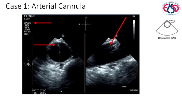 2 - Advanced ECMO Management Strategies.pdf | Heart and Cardiovascular ...