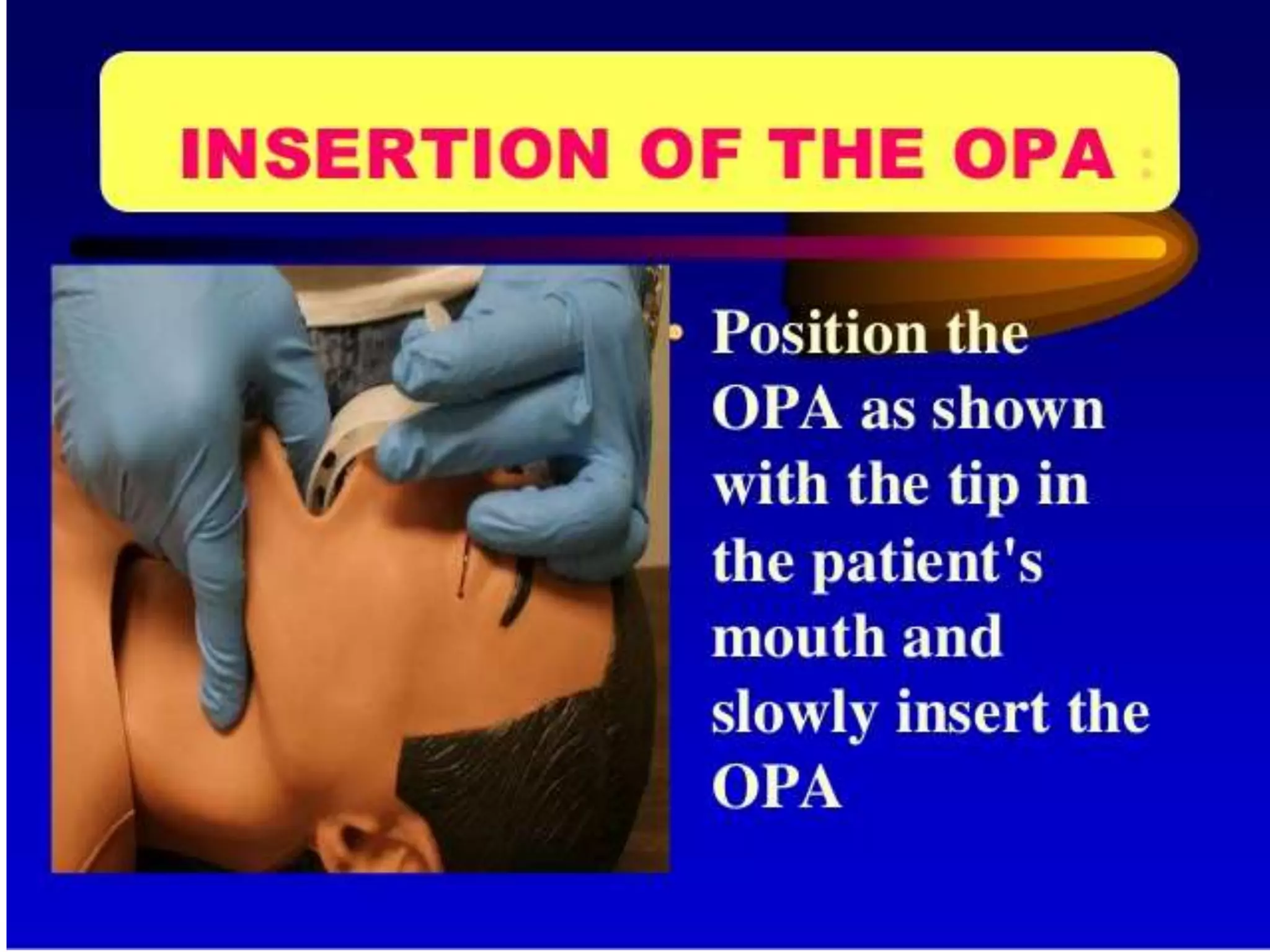 Airway Emergencies - by Dr. Ahmed Azab - ER consultant | PPTX