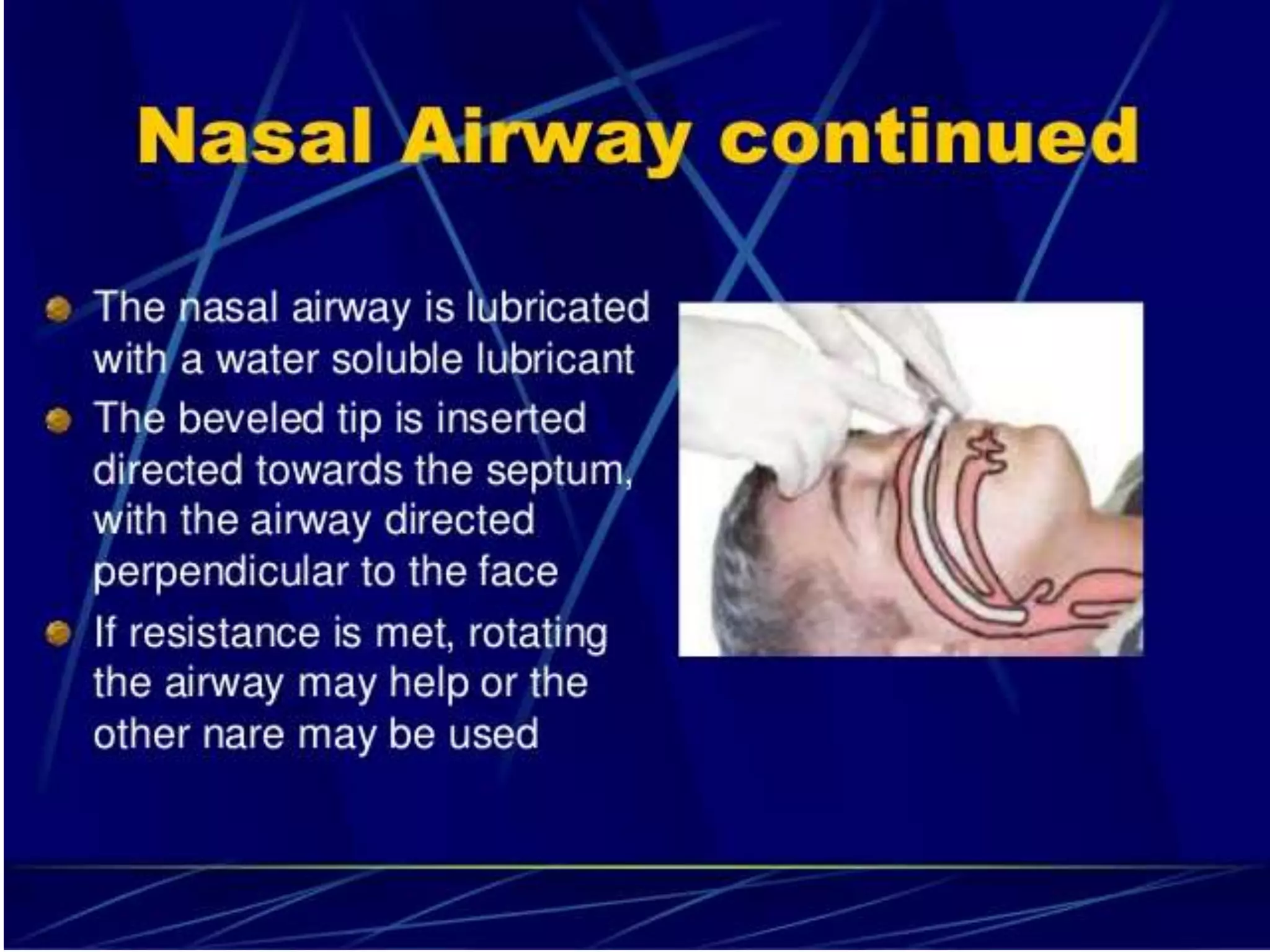 Airway Emergencies - by Dr. Ahmed Azab - ER consultant | PPTX