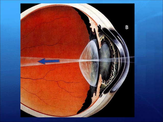 2- anatomy and physiology of the eye (Dr. essam.ppt