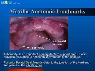 2.anatomy of the denture foundation areas | PPT
