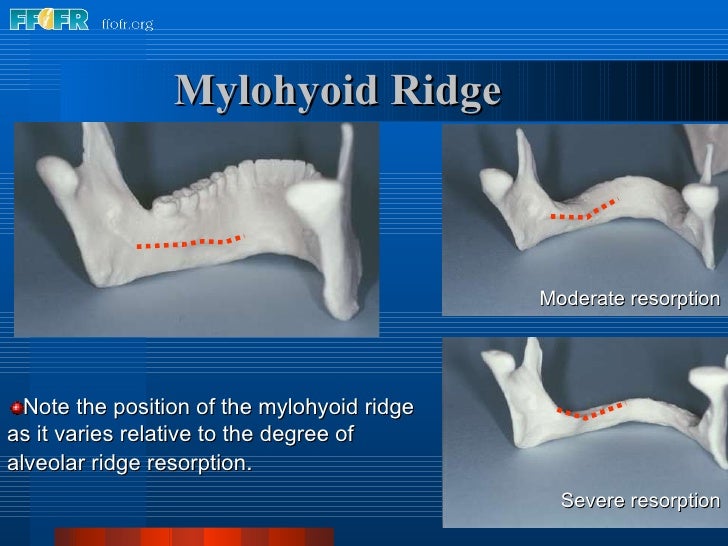 2.anatomy of the denture foundation areas