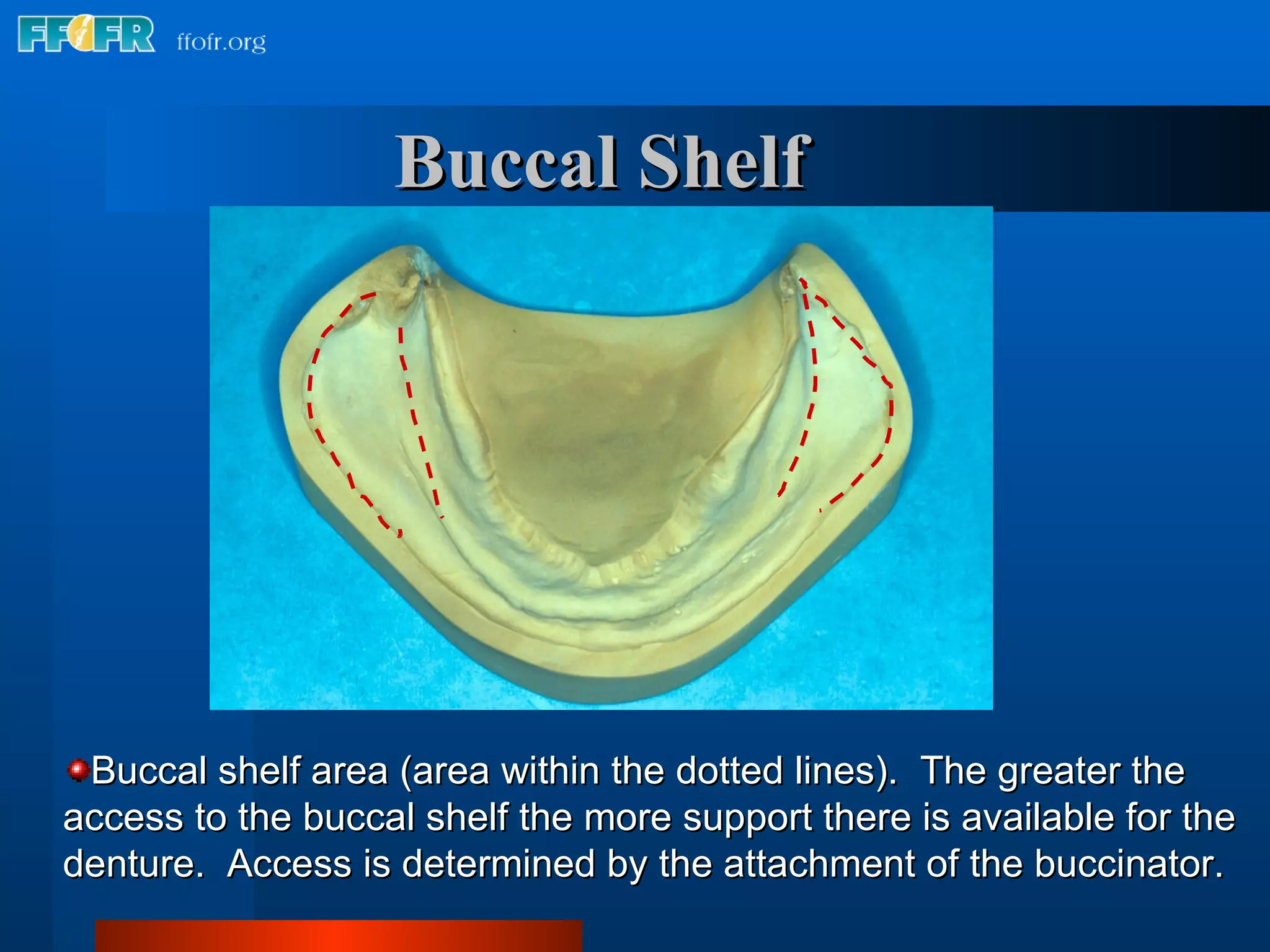 2.anatomy of the denture foundation areas | PPT