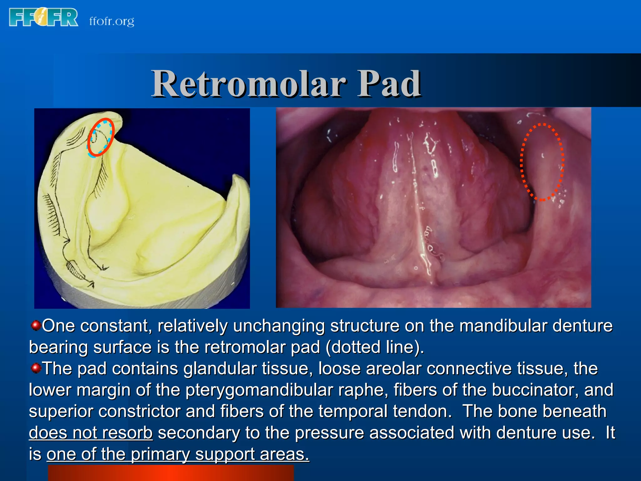 2.anatomy of the denture foundation areas | PPT