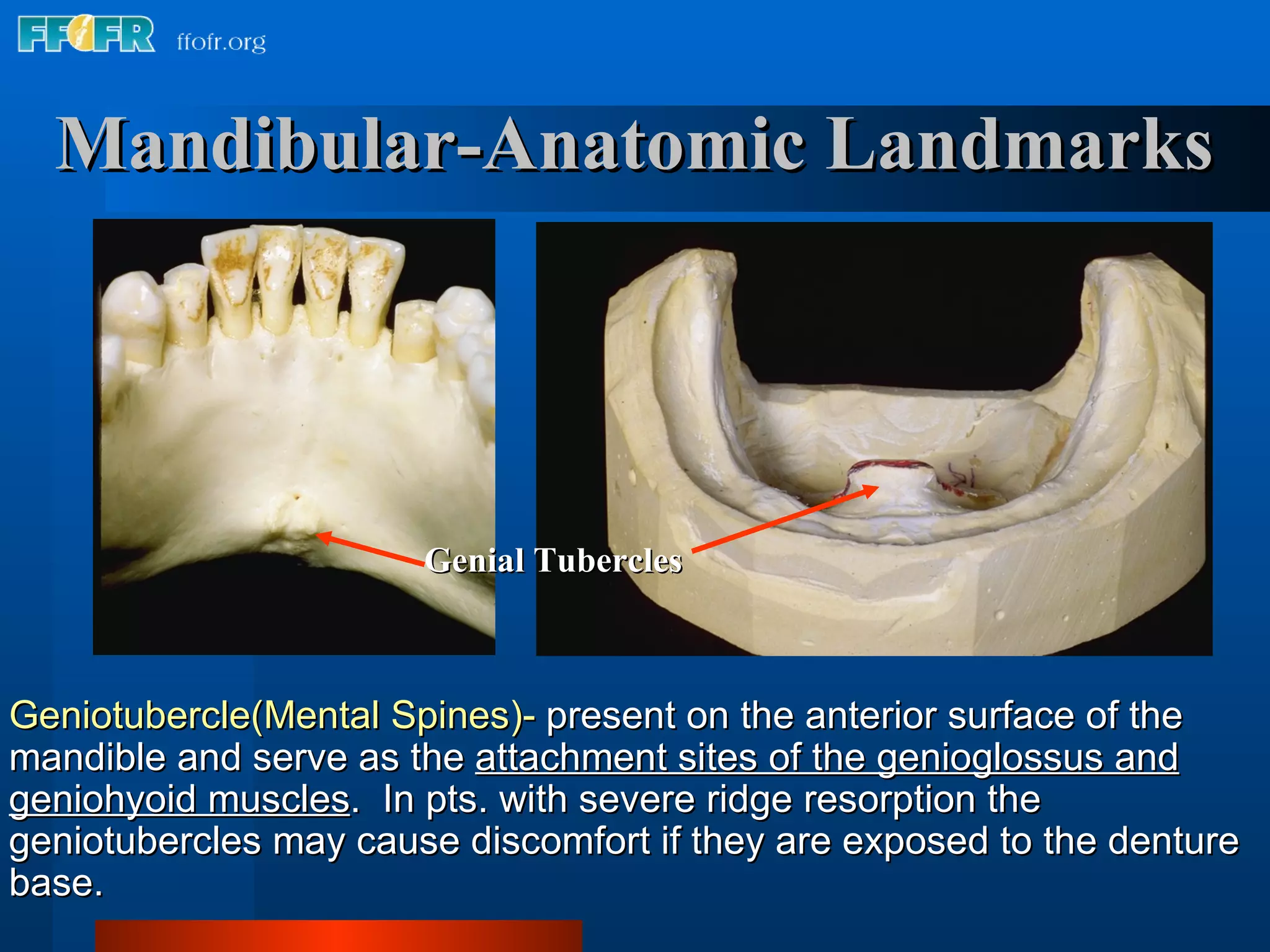 2.anatomy of the denture foundation areas | PPT