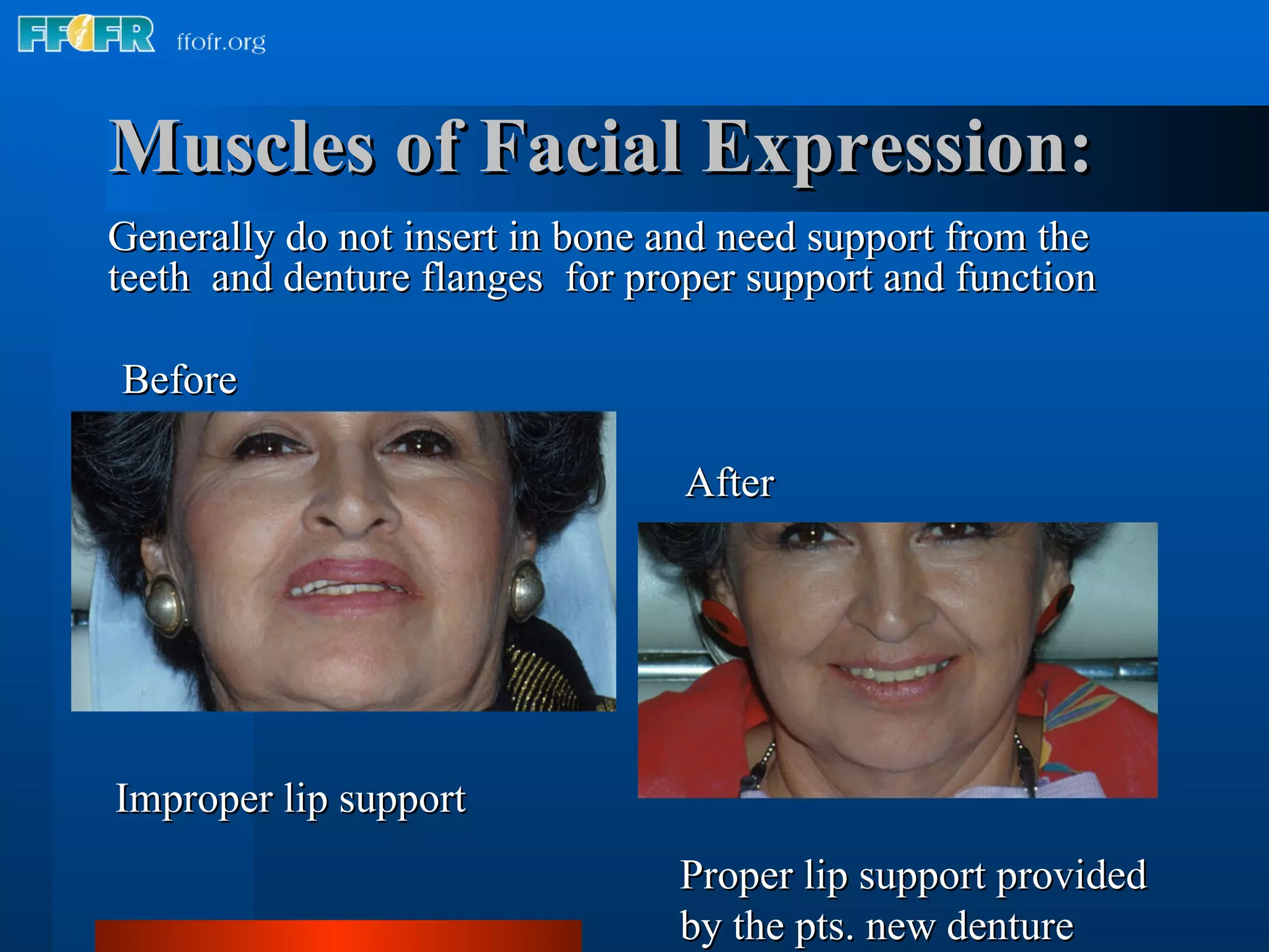 2.anatomy of the denture foundation areas | PPT