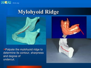 Mylohyoid Ridge Denture