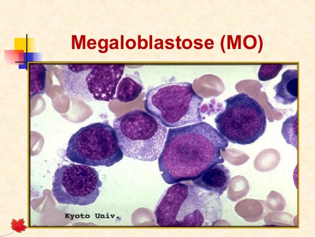 2 anemias - visão geral