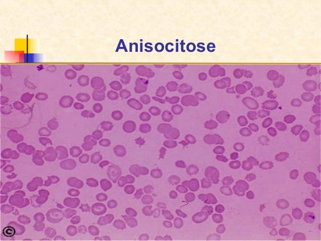 2 anemias - visão geral