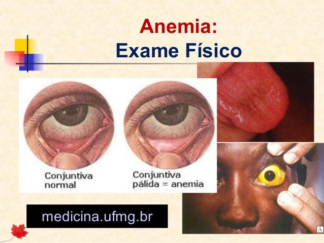 2 Anemias - Visão Geral