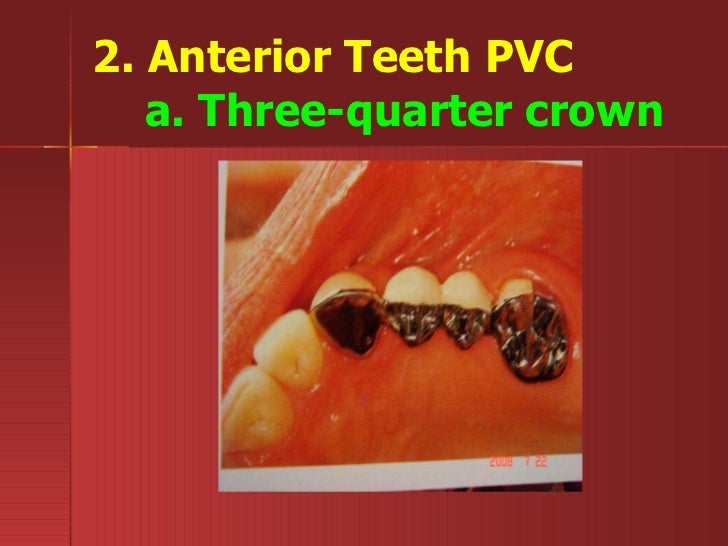 2. artificial crowns partial veneer crowns -midterm2