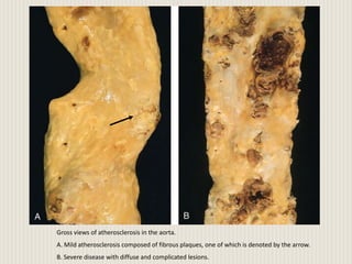 CVS pathology 2- atherosclerosis 2019, sufia husain | PPTX