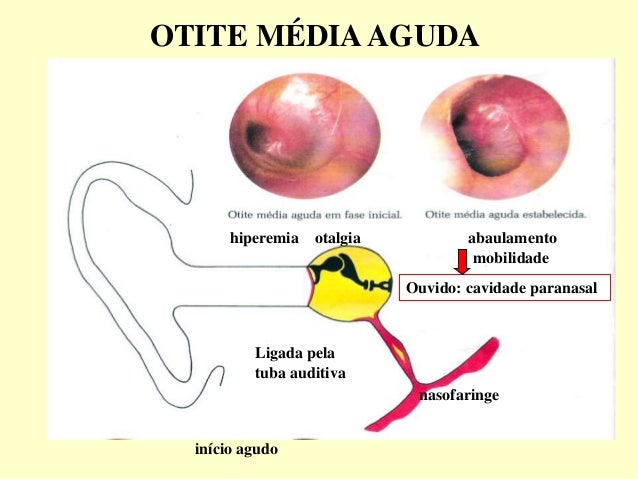Pediatria: Otite