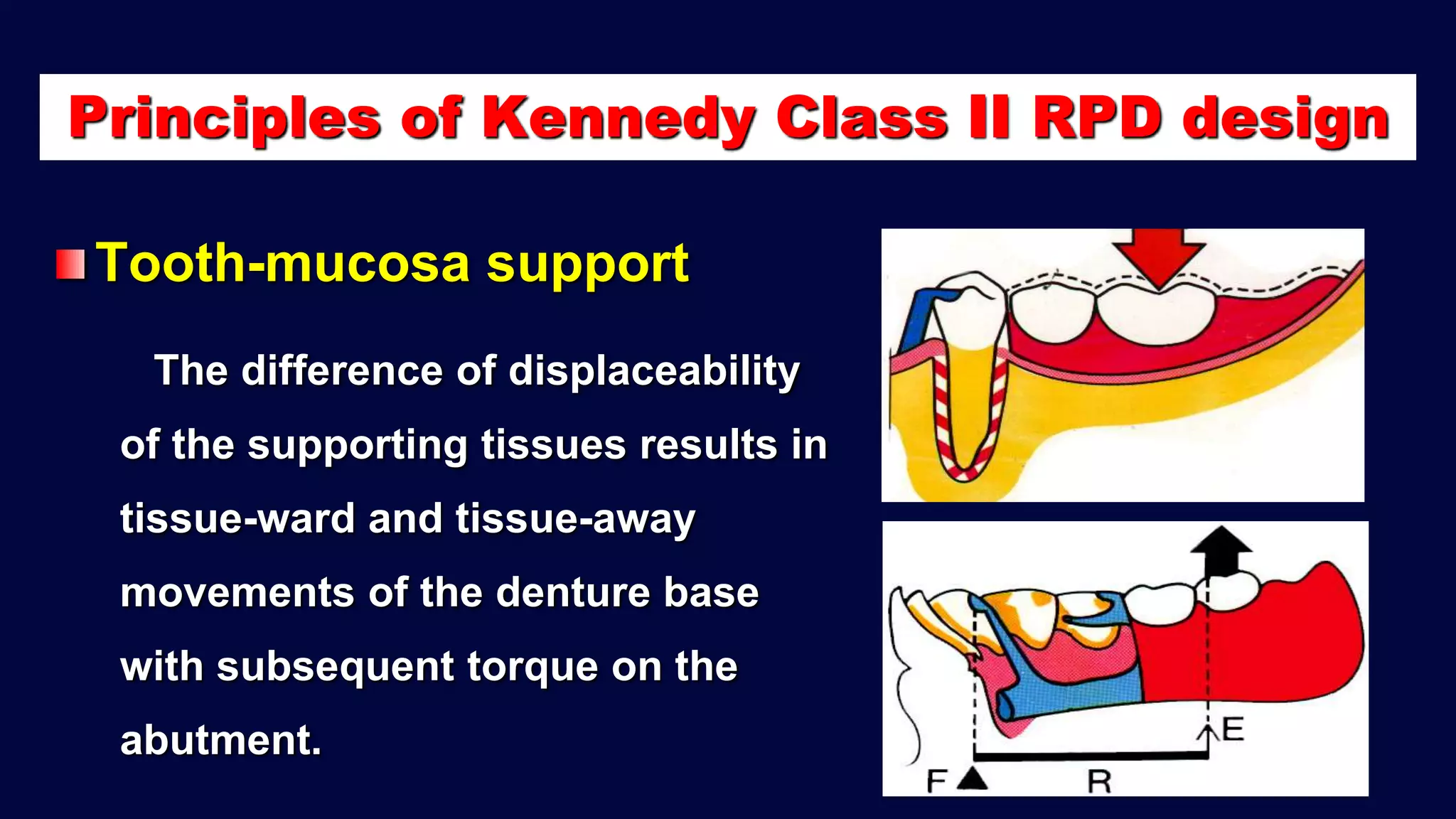 2- b. Basic principles for designing Kennedy class II, III and IV ...