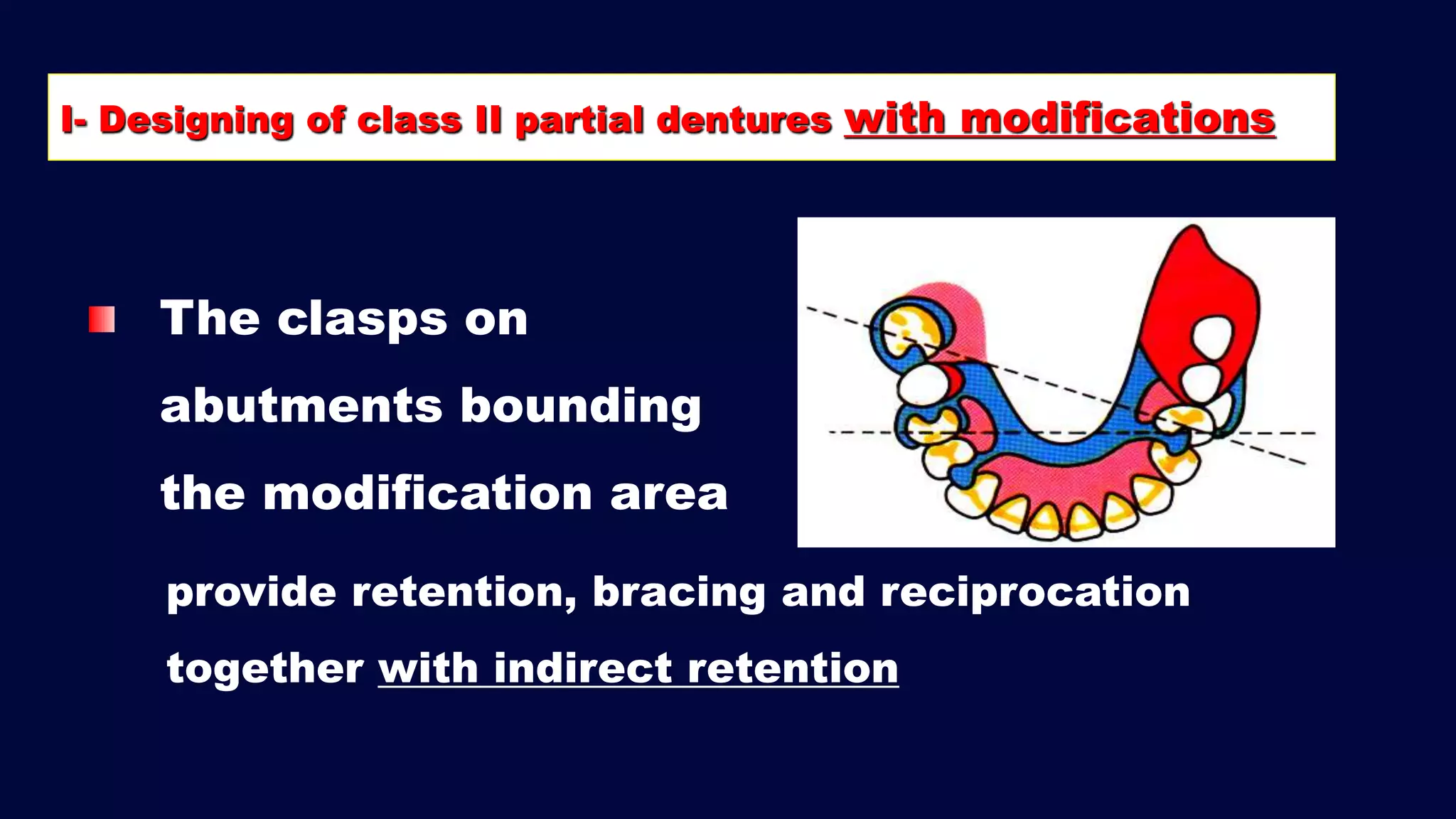 2- b. Basic principles for designing Kennedy class II, III and IV ...