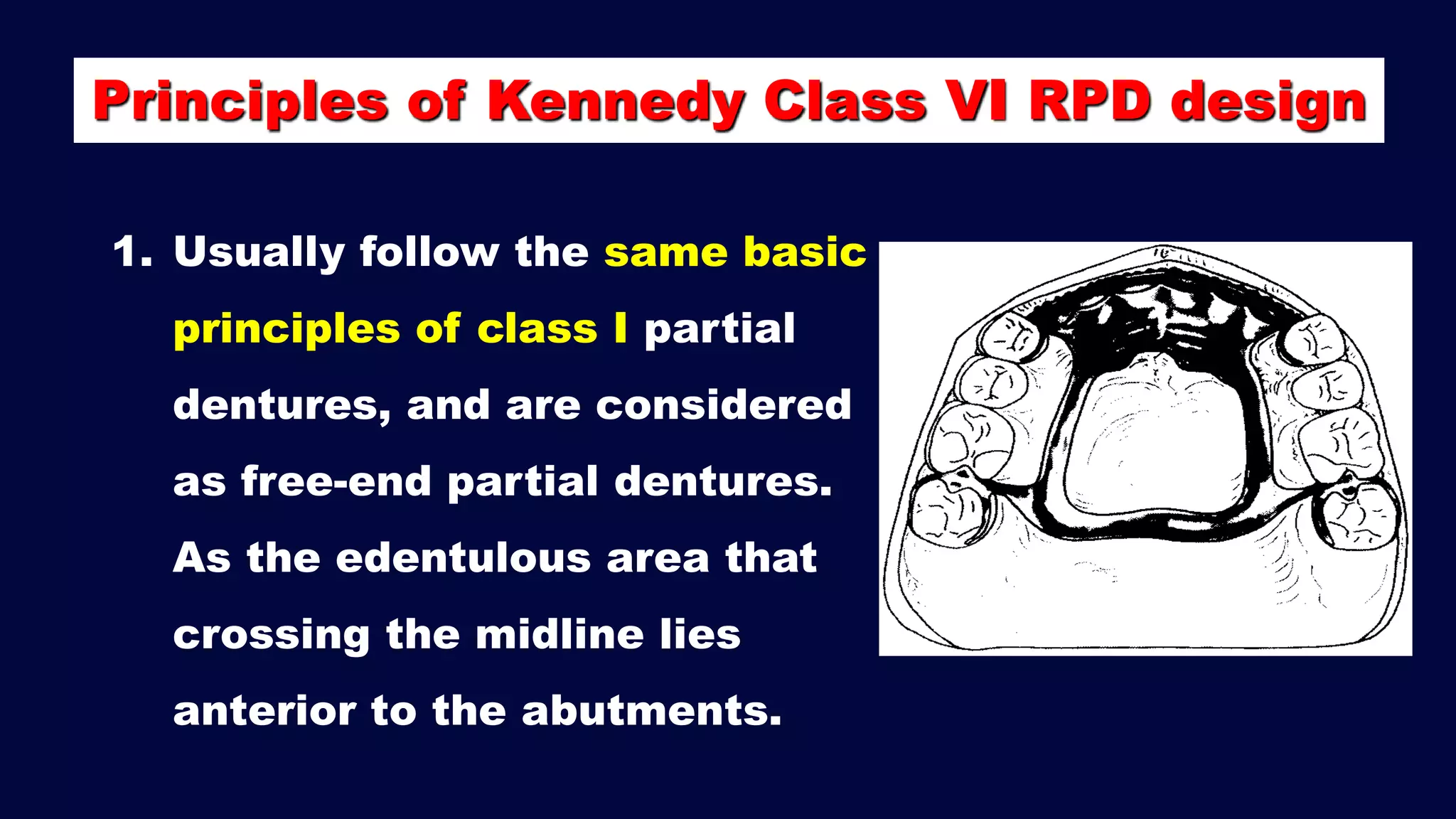 2- b. Basic principles for designing Kennedy class II, III and IV ...