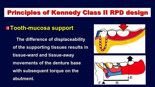 2- b. Basic principles for designing Kennedy class II, III and IV ...
