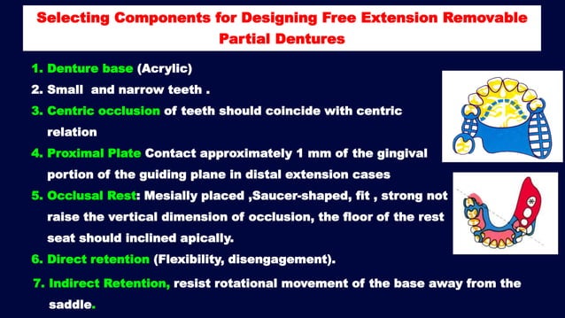 2- b. Basic principles for designing Kennedy class II, III and IV ...