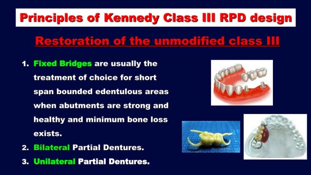 2- b. Basic principles for designing Kennedy class II, III and IV ...
