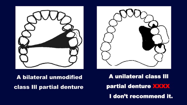 2- b. Basic principles for designing Kennedy class II, III and IV ...