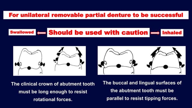 2- b. Basic principles for designing Kennedy class II, III and IV ...