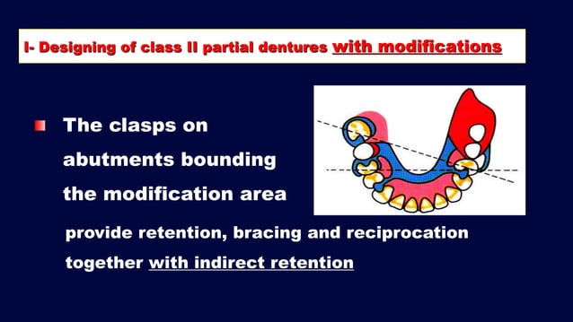 2- b. Basic principles for designing Kennedy class II, III and IV ...