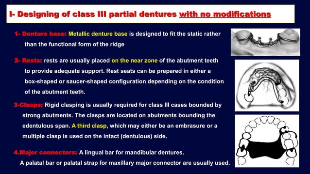 2- b. Basic principles for designing Kennedy class II, III and IV ...
