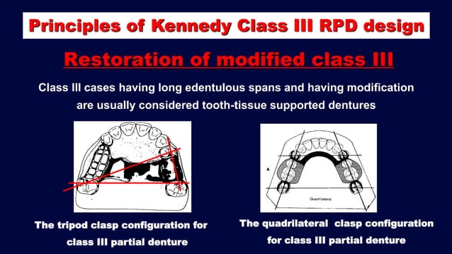 2- b. Basic principles for designing Kennedy class II, III and IV ...