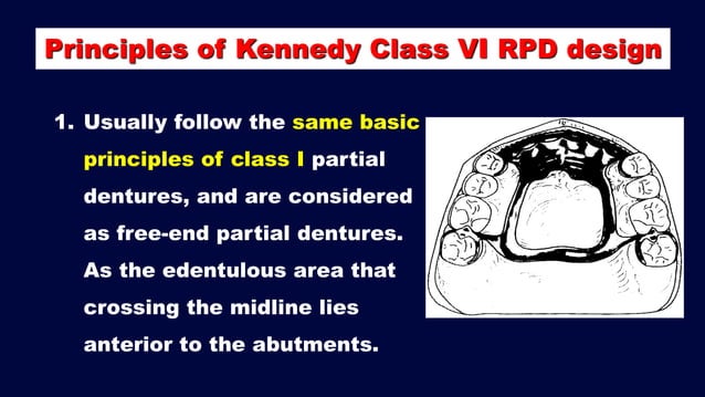 2- b. Basic principles for designing Kennedy class II, III and IV ...