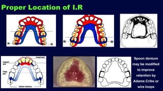 2- b. Basic principles for designing Kennedy class II, III and IV ...