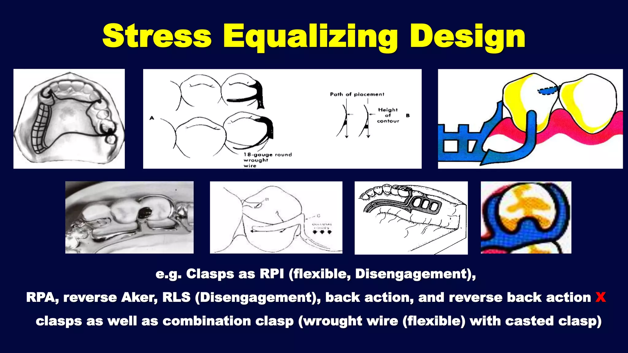 2- b. Basic principles for designing Kennedy class II, III and IV RPD ...