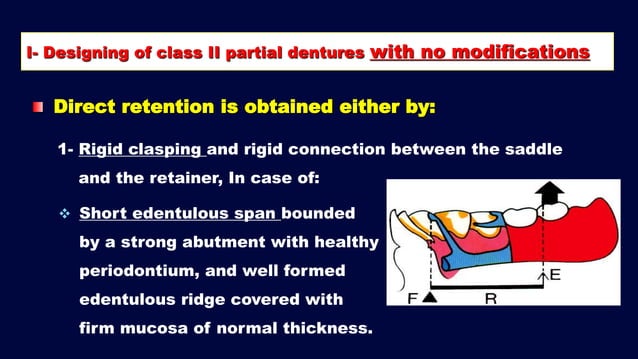2- b. Basic principles for designing Kennedy class II, III and IV RPD ...