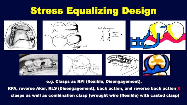 2- b. Basic principles for designing Kennedy class II, III and IV RPD ...
