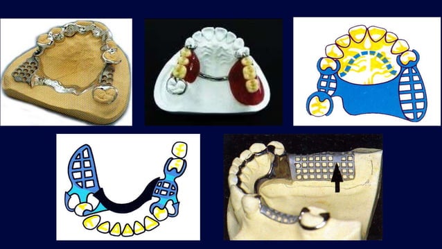 2- b. Basic principles for designing Kennedy class II, III and IV RPD ...