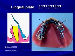 3- Basic principles for designing the removable partial denture | PPT