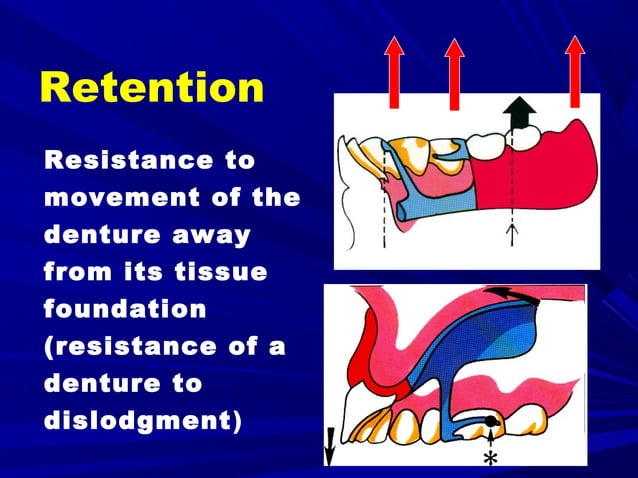 3- Basic principles for designing the removable partial denture | PPT