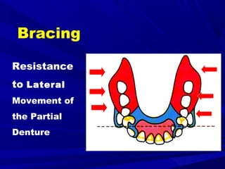 3- Basic principles for designing the removable partial denture | PPT