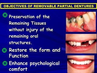 3- Basic principles for designing the removable partial denture | PPT
