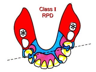 3- Basic principles for designing the removable partial denture | PPT