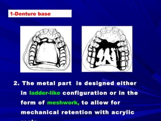 3- Basic principles for designing the removable partial denture | PPT