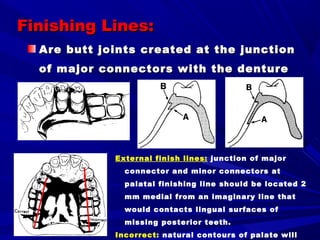 3- Basic principles for designing the removable partial denture | PPT