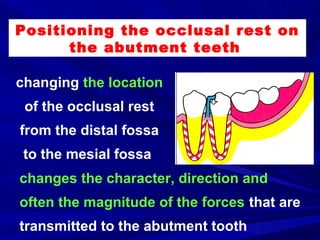 3- Basic principles for designing the removable partial denture | PPT