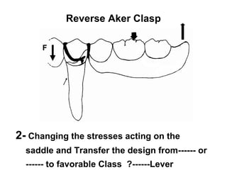 3- Basic principles for designing the removable partial denture | PPT