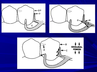 3- Basic principles for designing the removable partial denture | PPT
