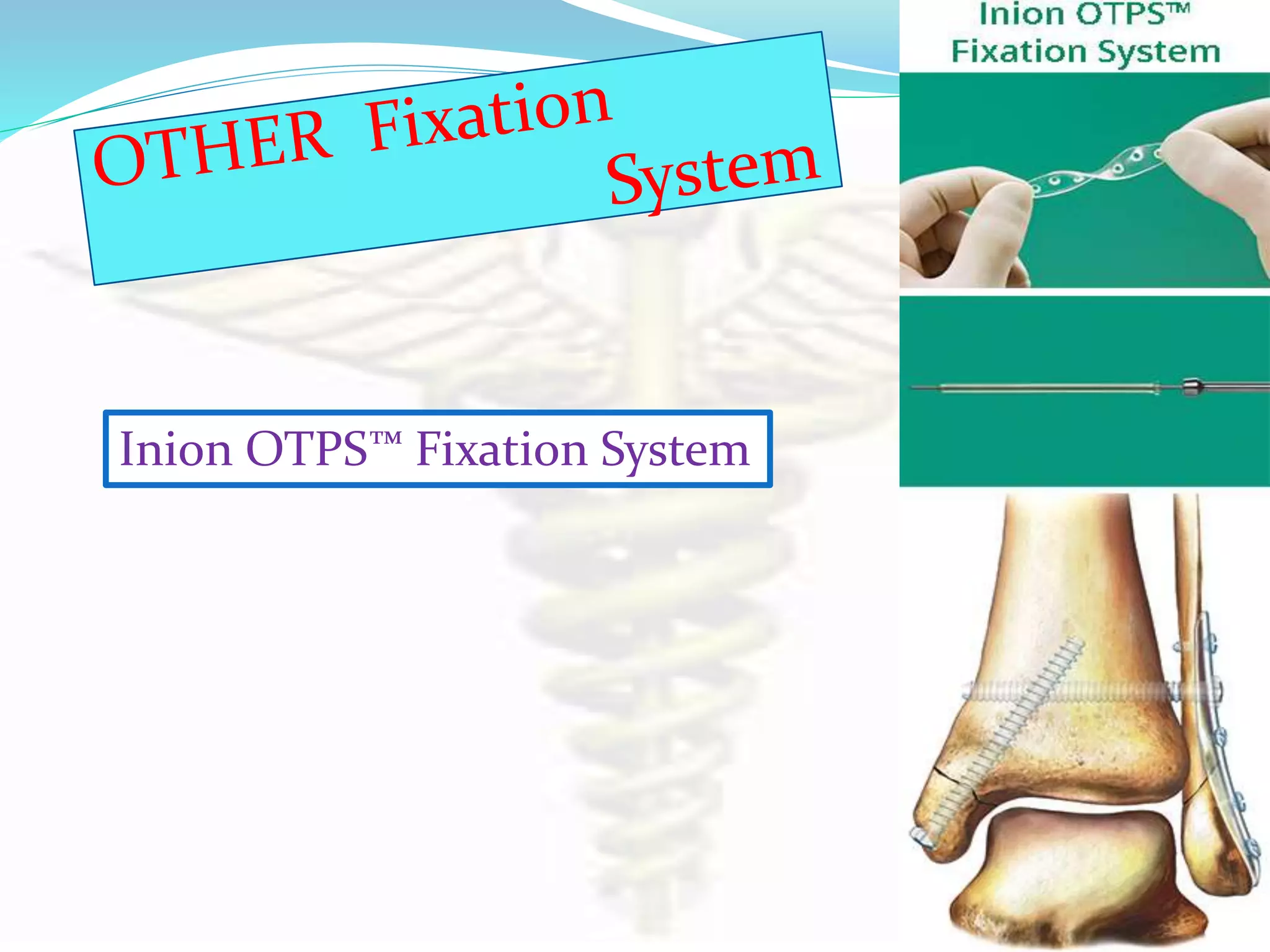 2 bio resorbable plates as effective implant in pediatric mandibular ...