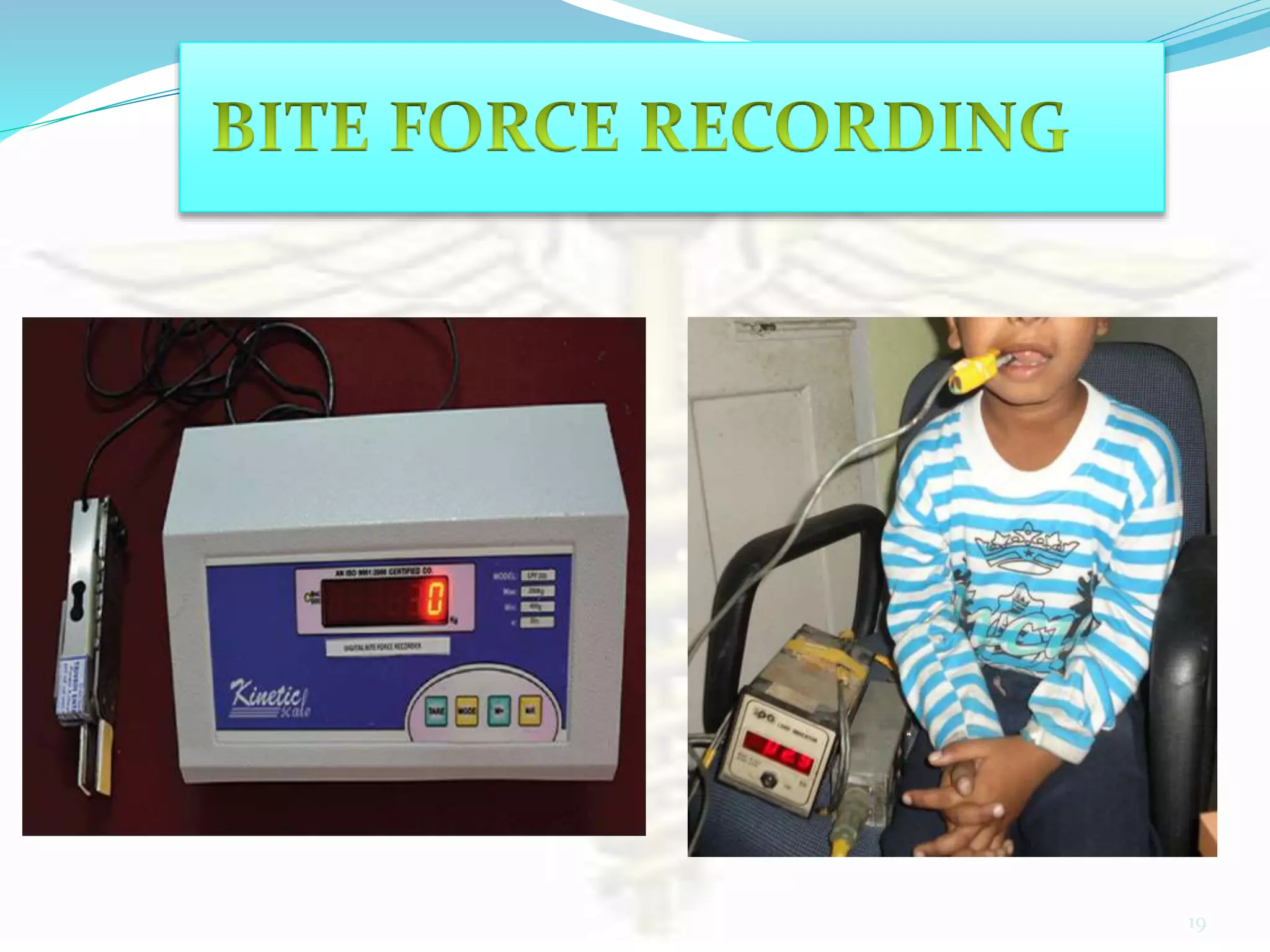 2 bio resorbable plates as effective implant in pediatric mandibular ...