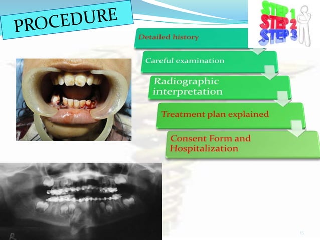 2 bio resorbable plates as effective implant in pediatric mandibular ...
