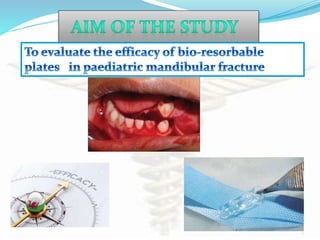 2 bio resorbable plates as effective implant in pediatric mandibular ...